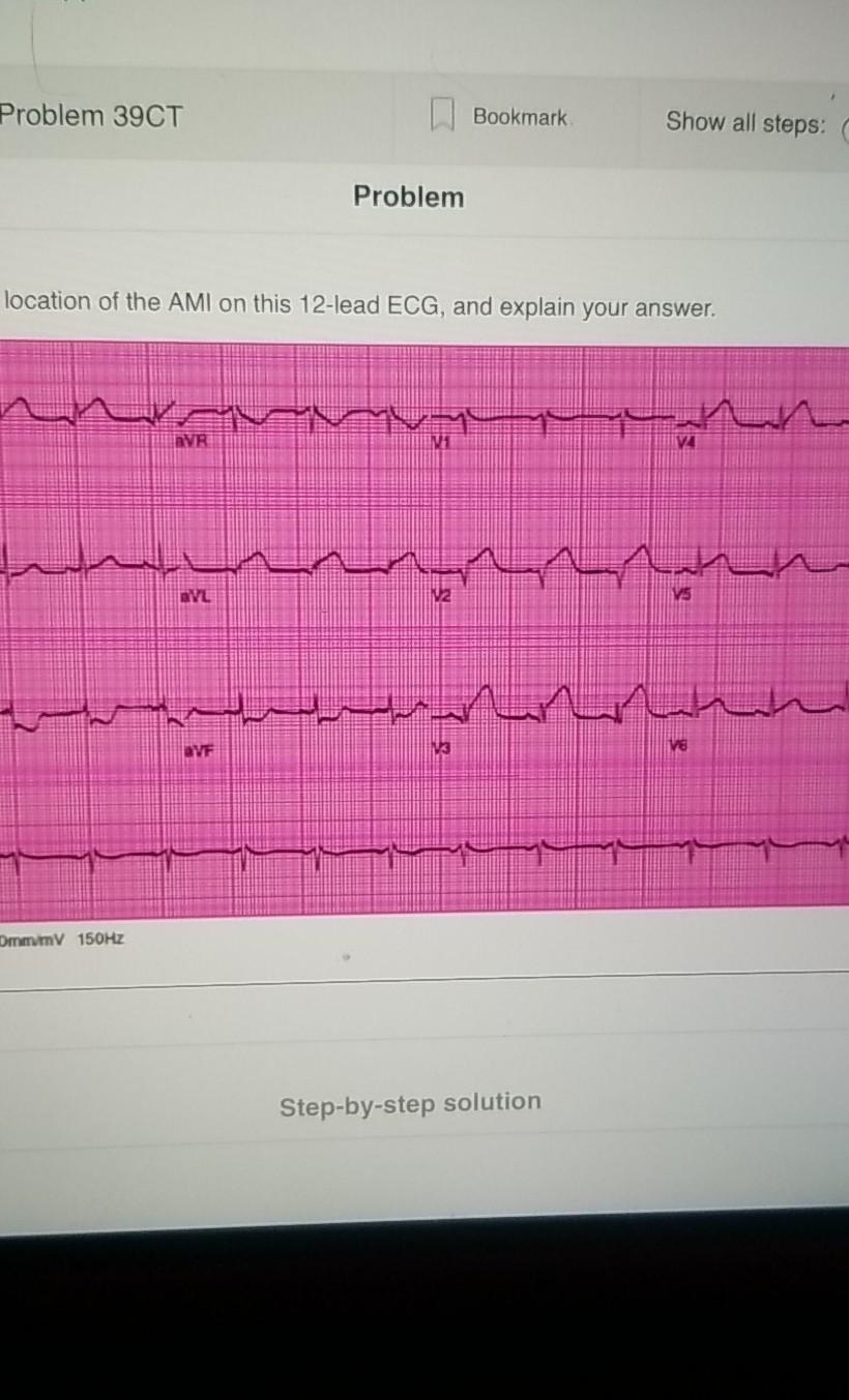 Solved identify the location of the AMI on this 12 lead ECG | Chegg.com