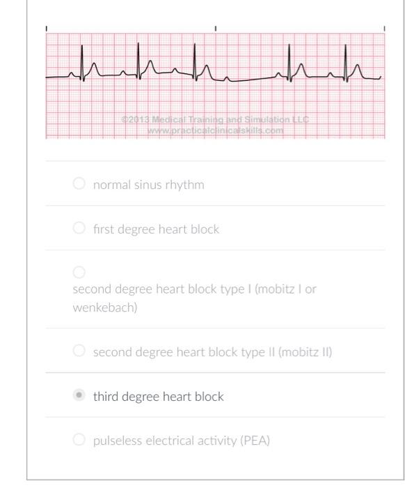 Solved normal sinus rhythm first degree heart block second | Chegg.com