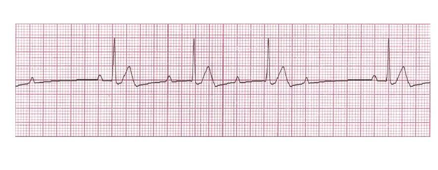 Solved Instructions: Step 1: Identify each of the three ECG | Chegg.com