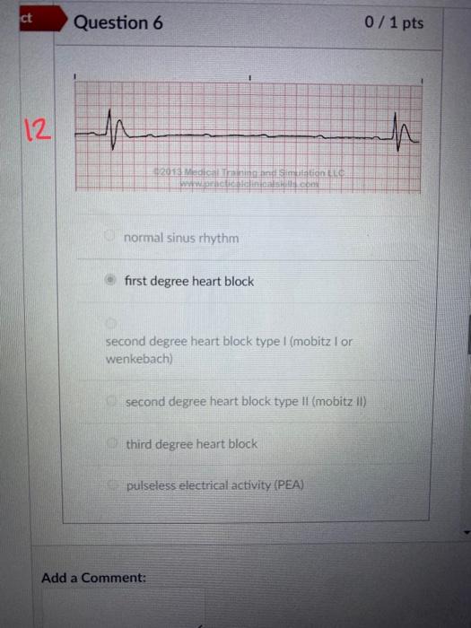 Solved normal sinus rhythm first degree heart block second | Chegg.com