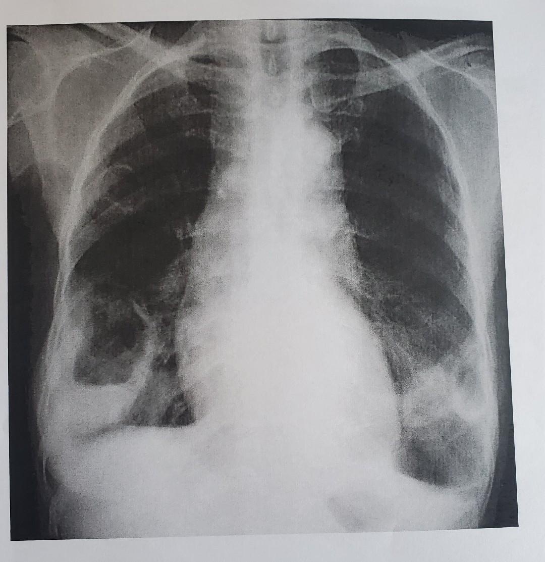 Solved 10- ﻿interpret this CXR and explain reasoning behind | Chegg.com