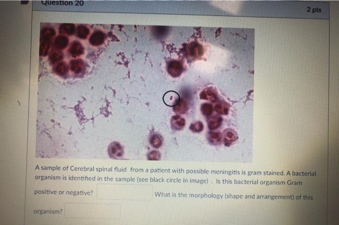 Solved A sample of Cerebral spinal fluid from a patient with | Chegg.com