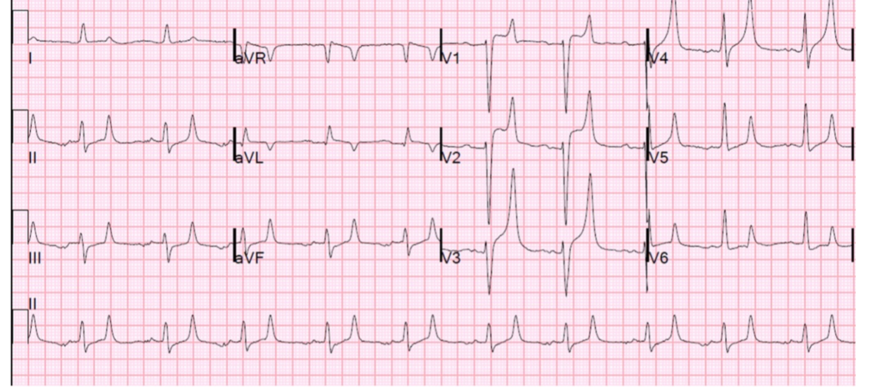 Solved The heart rate and rhythm of the below EKG is _____ | Chegg.com