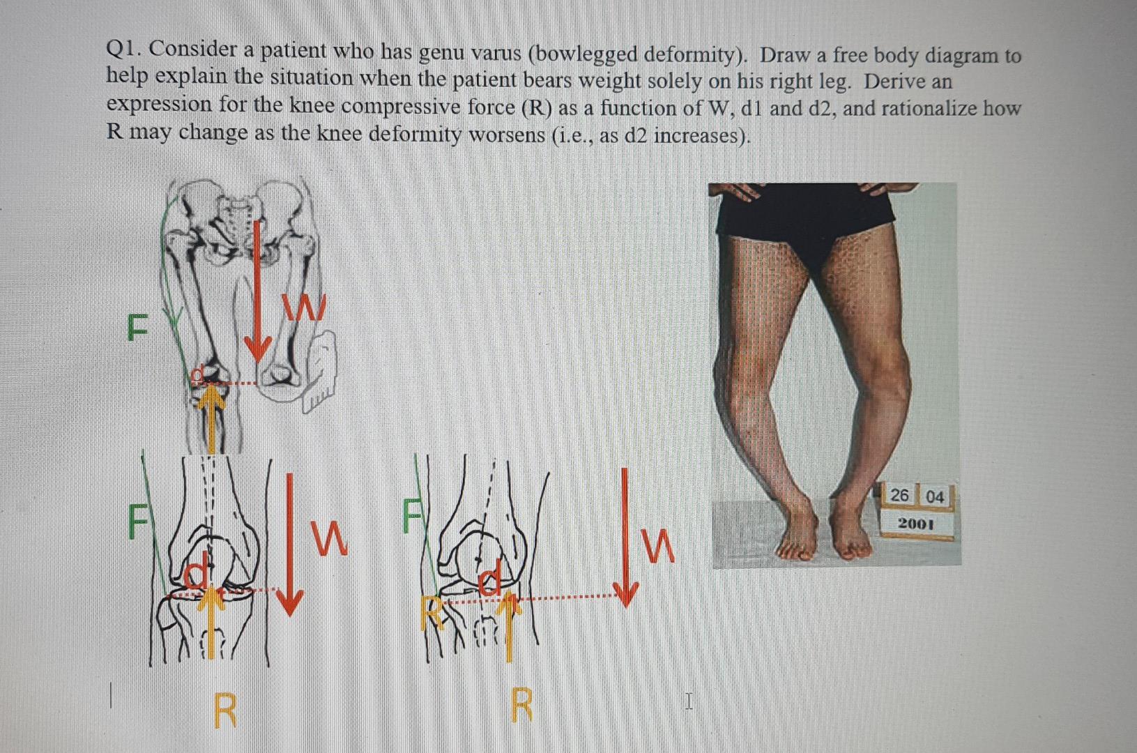 Solved Q1. Consider a patient who has genu varus (bowlegged | Chegg.com