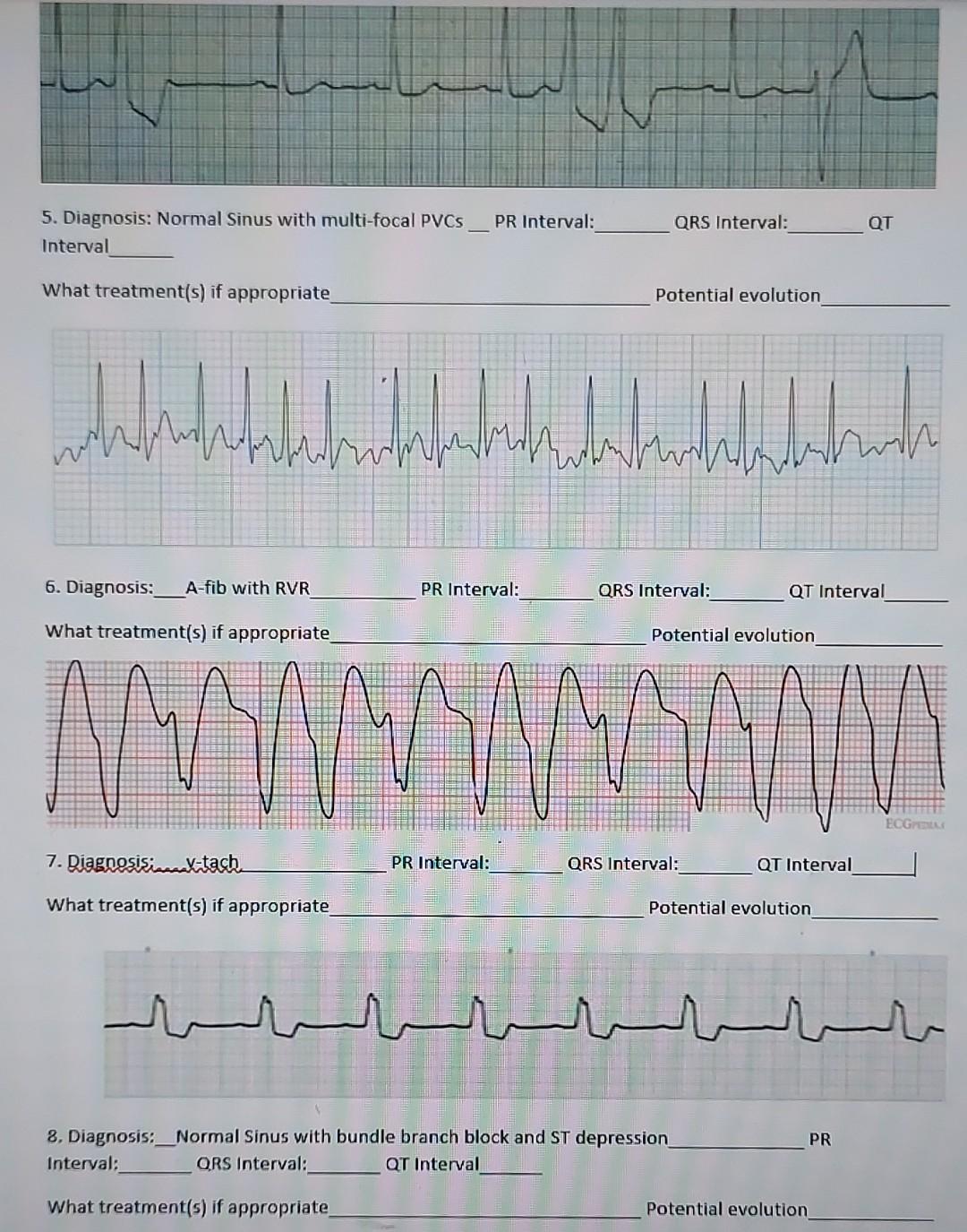 Solved PR Interval: 5. Diagnosis: Normal Sinus with | Chegg.com