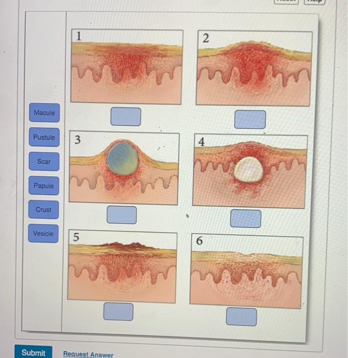 Solved 1 2 Macule Pustule 3 4 Scar m mu Papule Crust Vesicle | Chegg.com