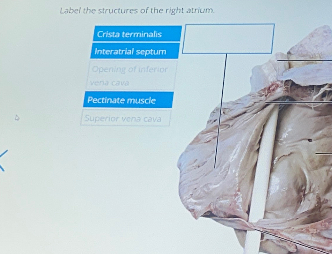 Solved Label the structures of the right atrium. | Chegg.com