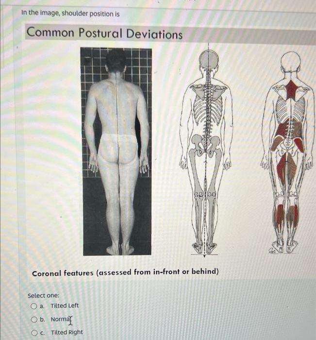 Solved Common Postural Deviations Coronal features (assessed | Chegg.com