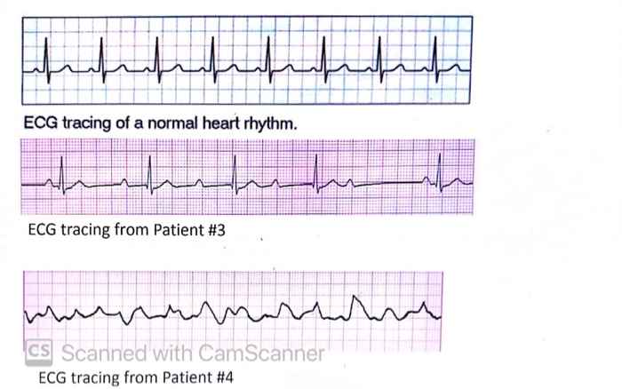 ECG Case Studies میلی لیلی لیلی لیلیا ECG tracing of | Chegg.com