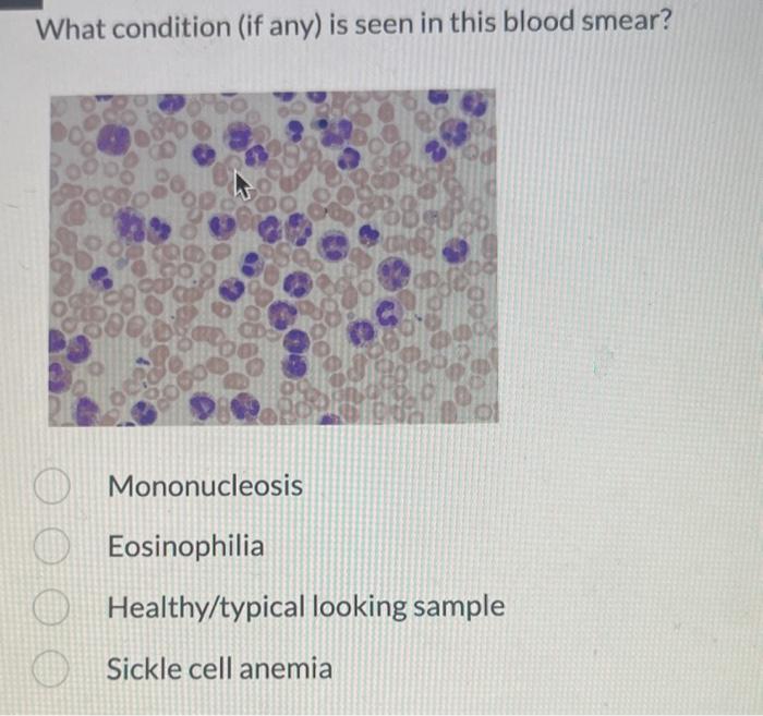 Solved What condition (if any) is seen in this blood smear? | Chegg.com