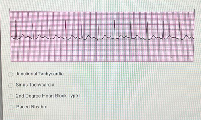 Solved Junctional Tachycardia Sinus Tachycardia 2nd Degree | Chegg.com