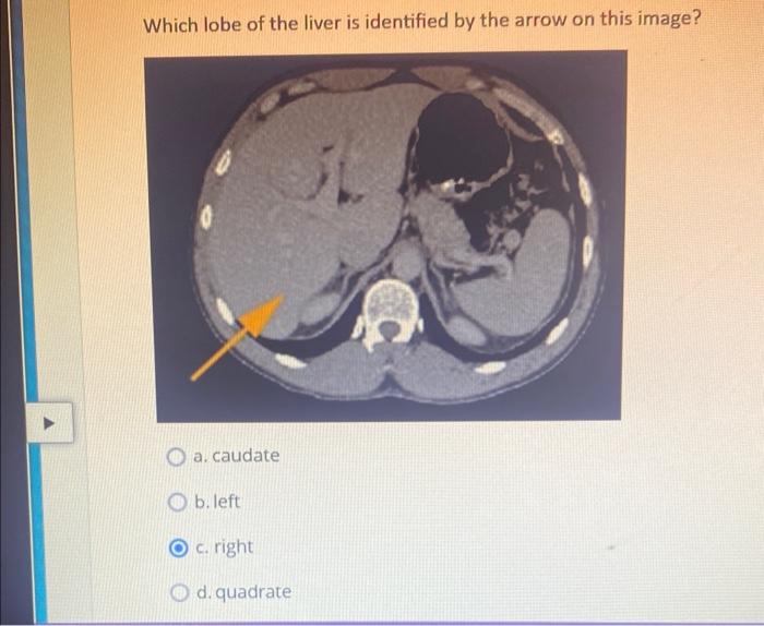 Solved which lobe of the liver is identified by the arrow on | Chegg.com
