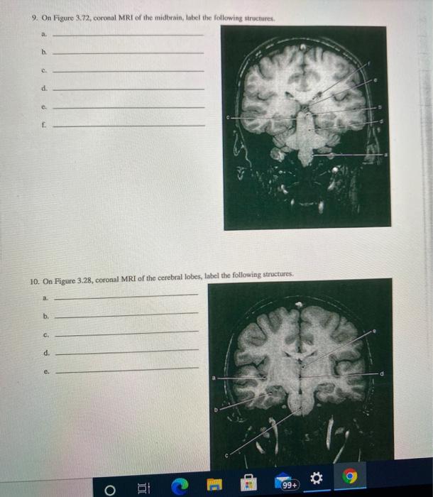 Solved 9. On Figure 3.72, coronal MRI of the midbrain, label | Chegg.com