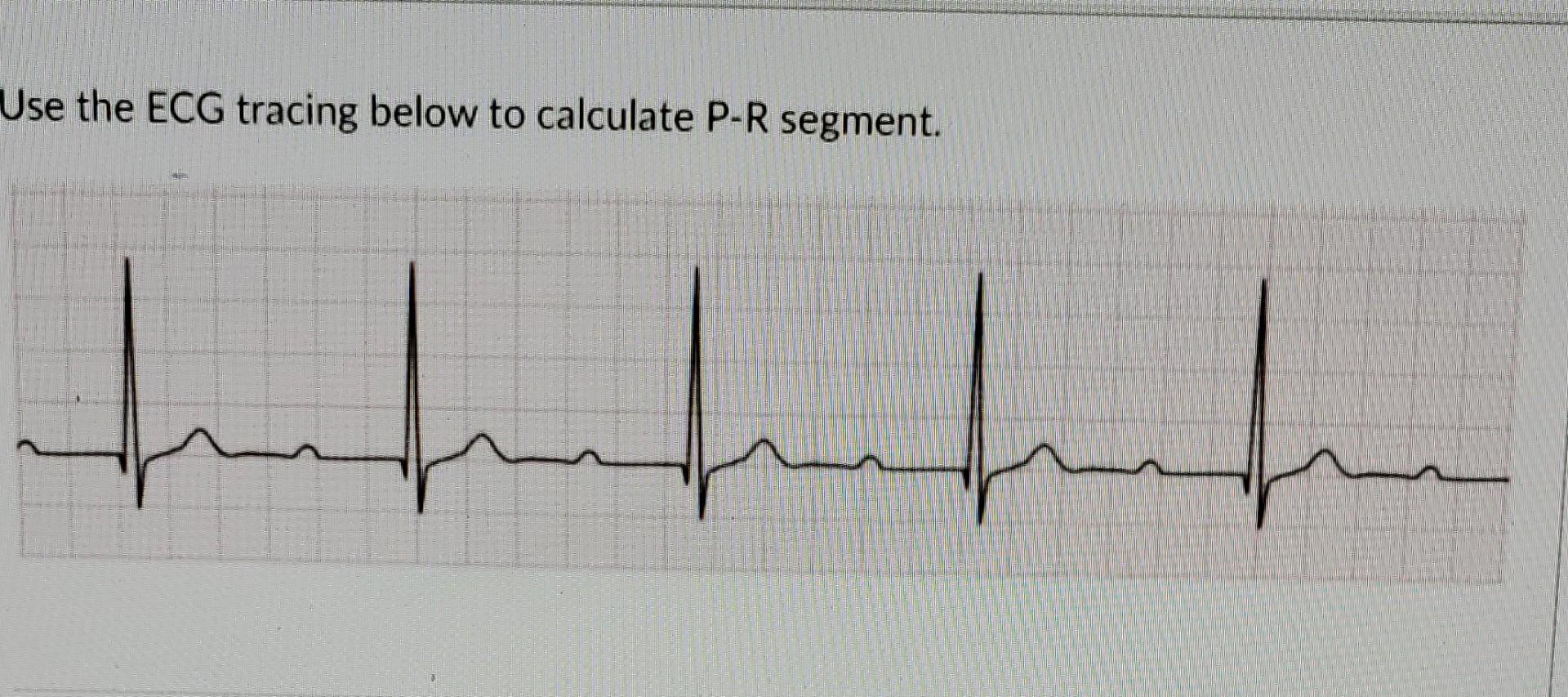 Solved Use the ECG tracing below to calculate P-R segment. | Chegg.com