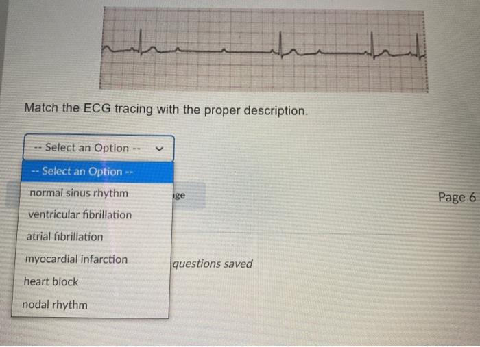 Solved بیمه بیملی Match the ECG tracing with the proper | Chegg.com