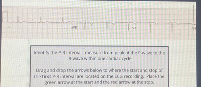 Solved Identify the P-R Interval: measure from peak of the | Chegg.com