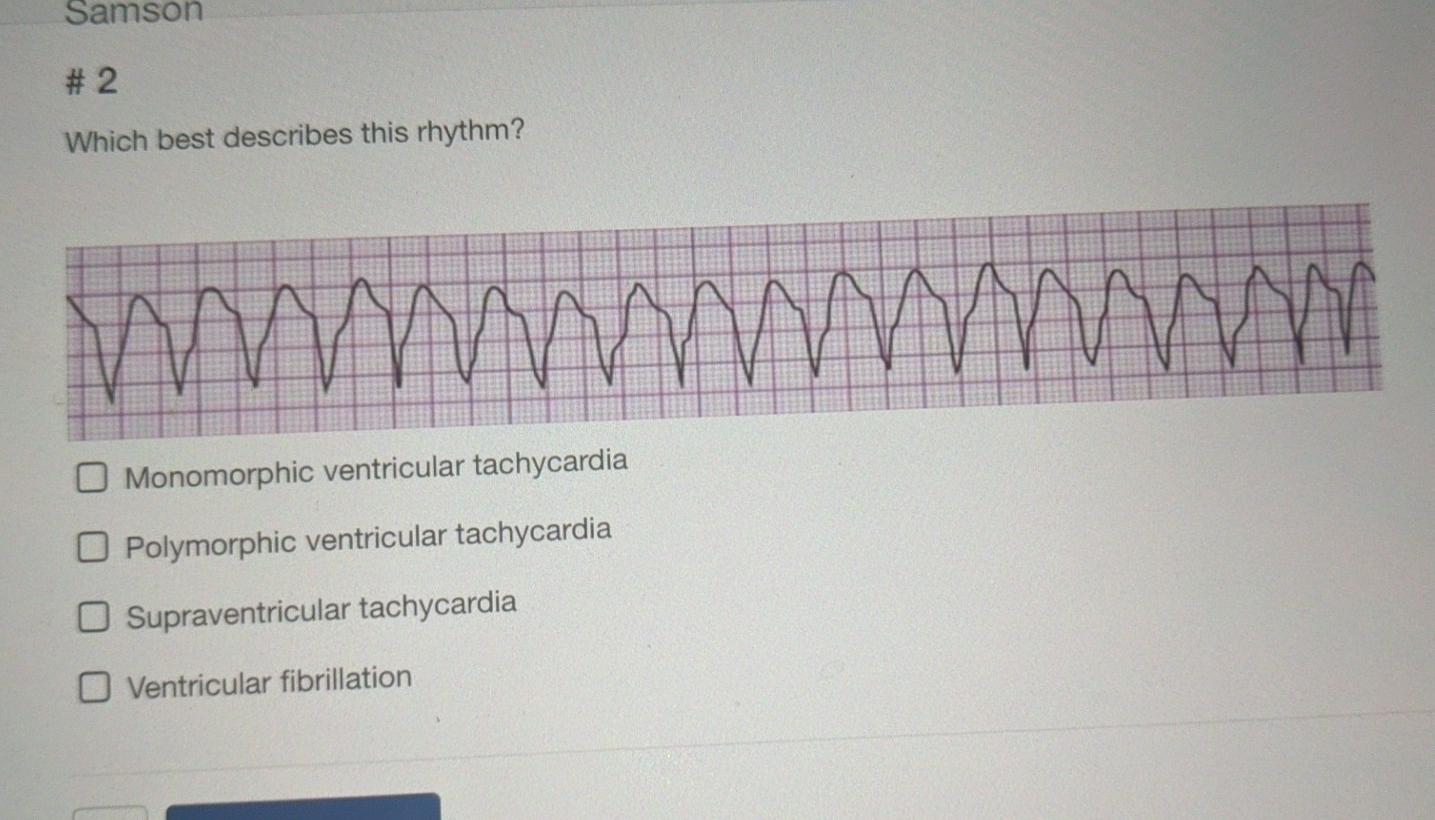 Ventricular Tachycardia Vs Supraventricular Tachycardia