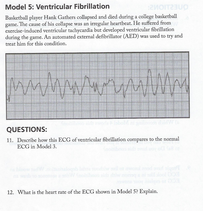 Solved Ventricular fibrillation (V-fib) ﻿is a condition of | Chegg.com