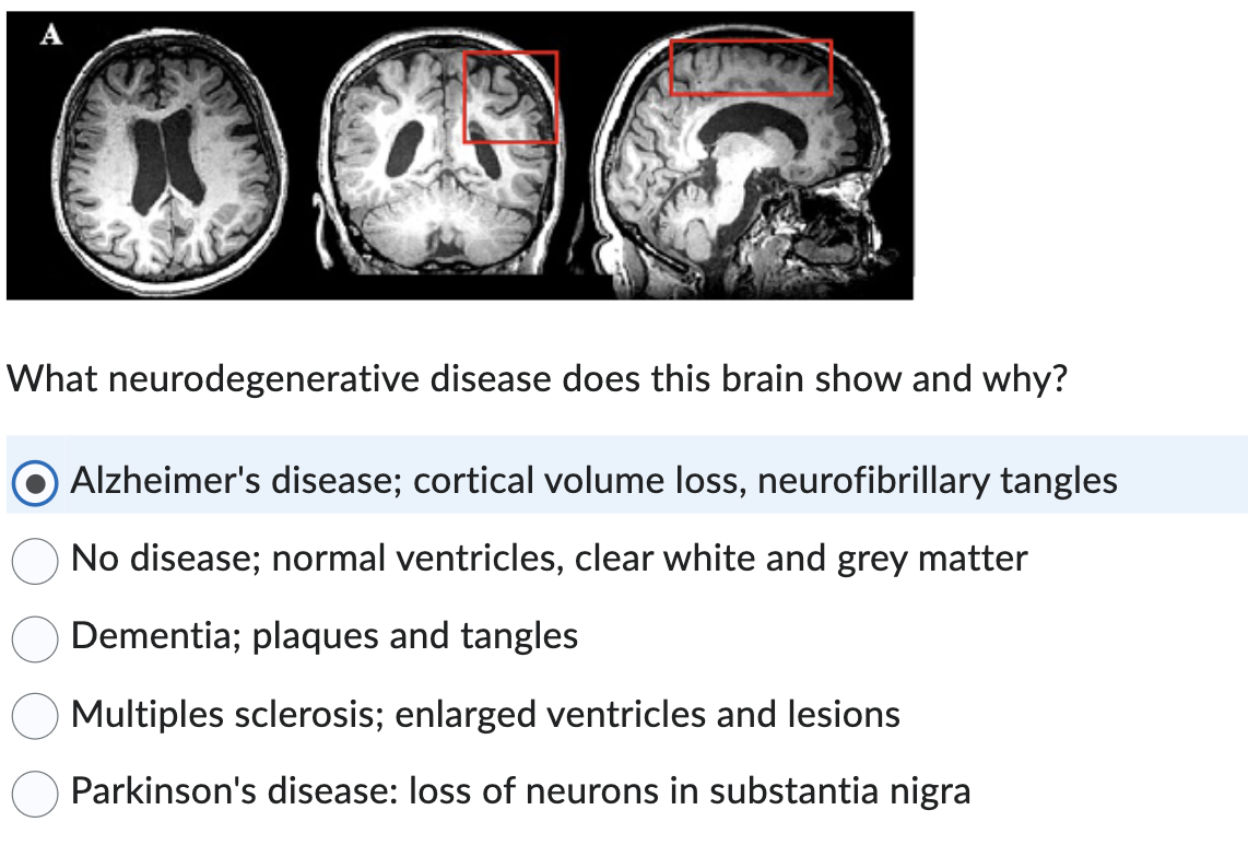 Solved AWhat neurodegenerative disease does this brain show | Chegg.com