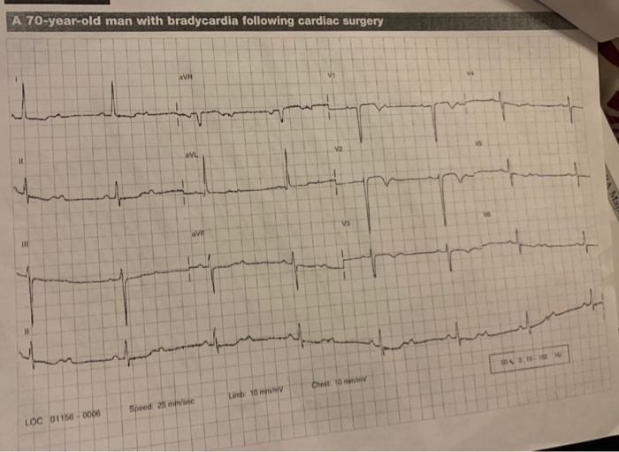 Solved A 70-year-old man with bradycardia following cardiac | Chegg.com