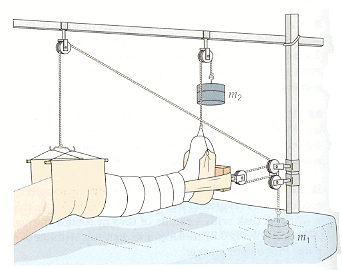 A variation of Russell traction (Fig. 8.34)supports | Chegg.com