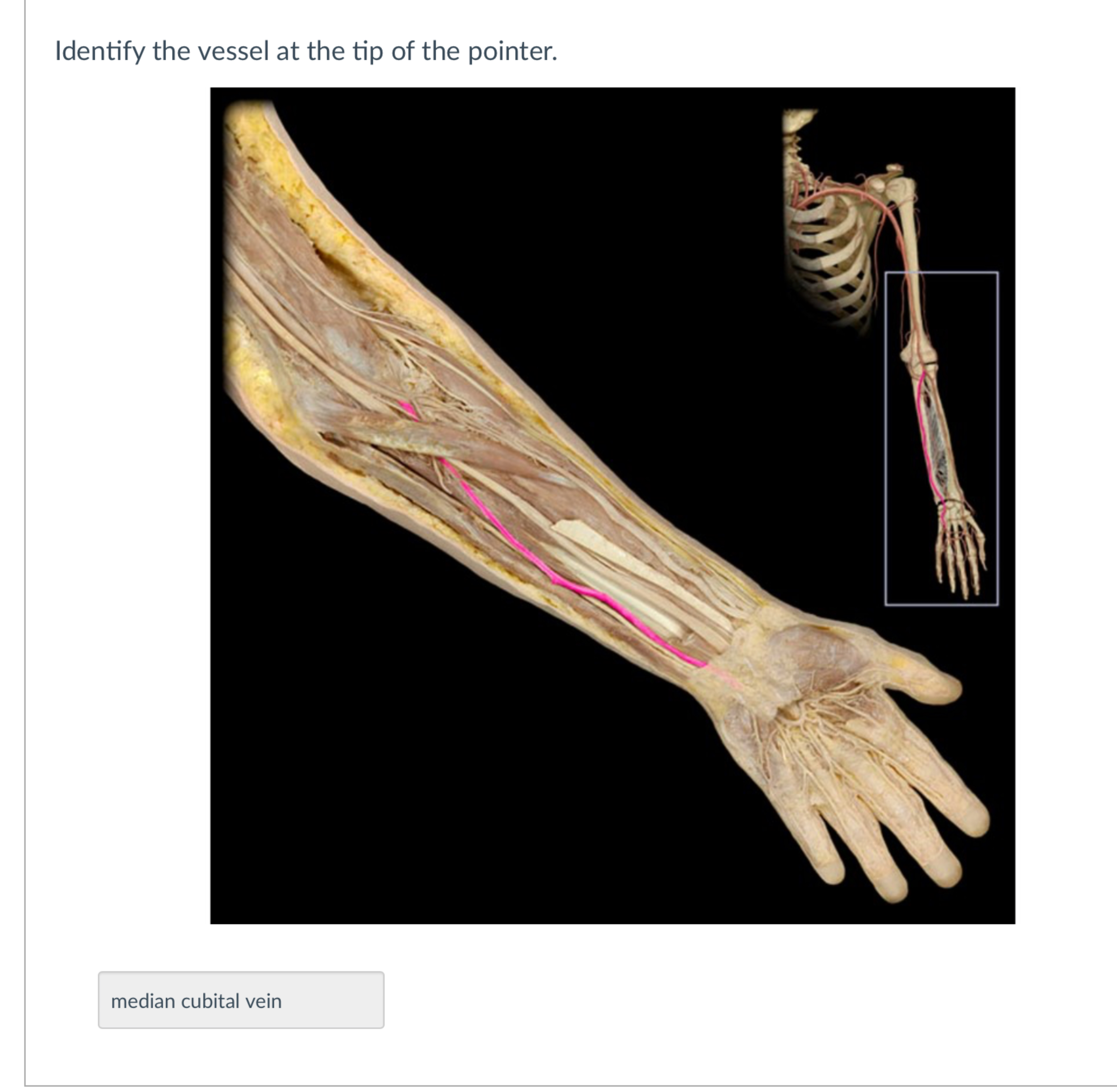 [Solved]: Identify the vessel at the tip of the pointer. Id