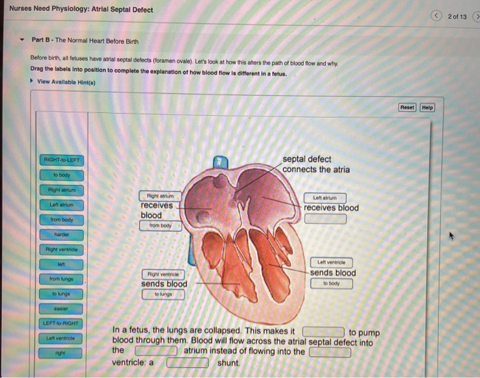 Solved Nurses Need Physiology: Atrial Septal Defect ② 20113 | Chegg.com