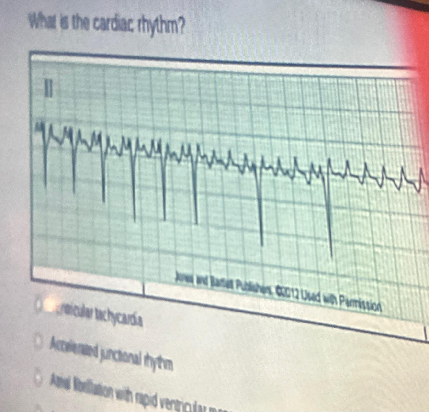 Solved What is the cardiac rhythm? ﻿Ventricular | Chegg.com