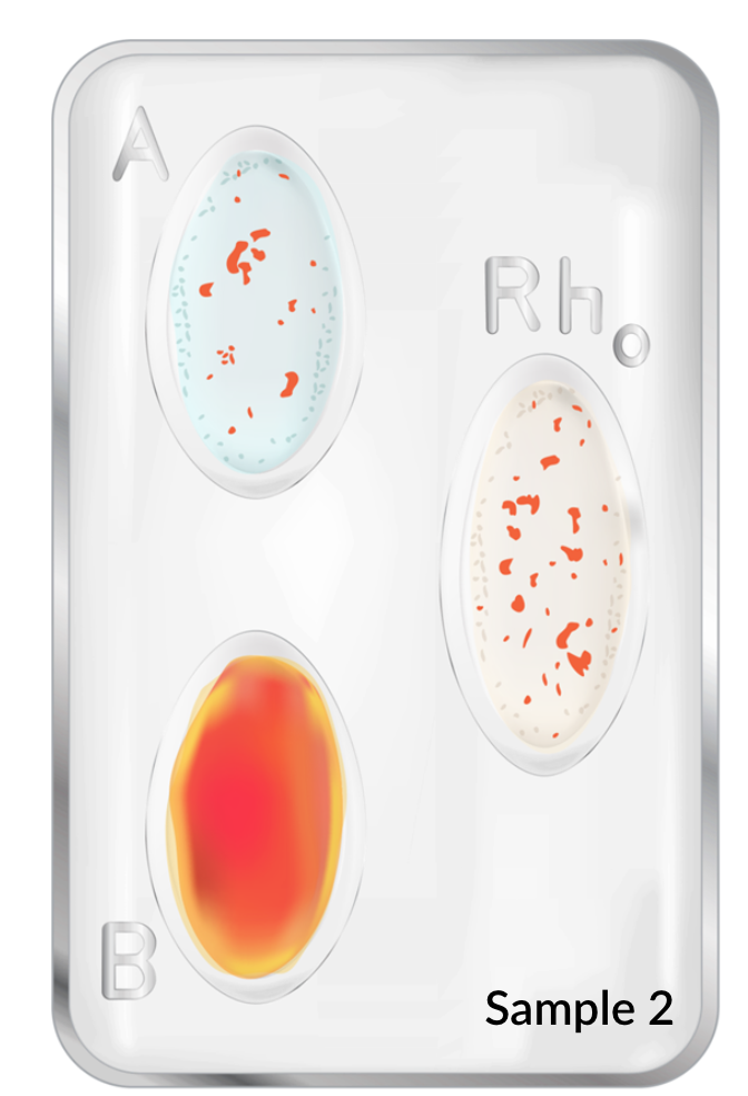 Solved Determine the blood type and explain your findings in | Chegg.com