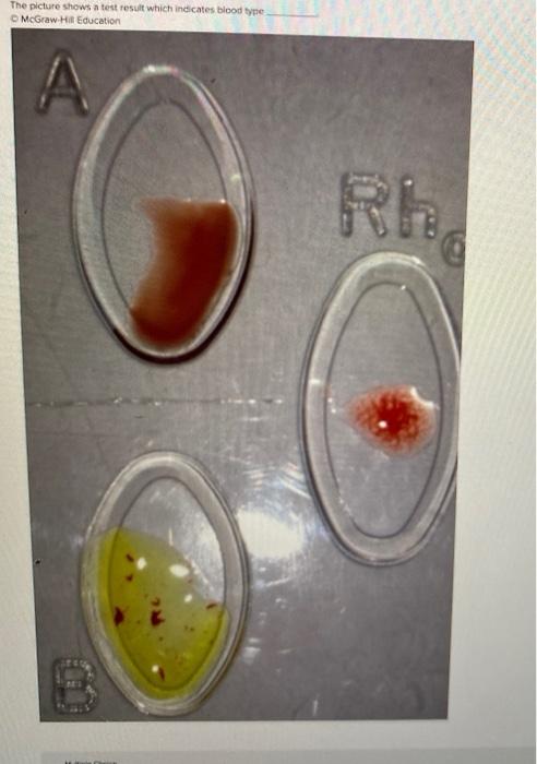 Solved The picture shows a test result which indicates blood | Chegg.com