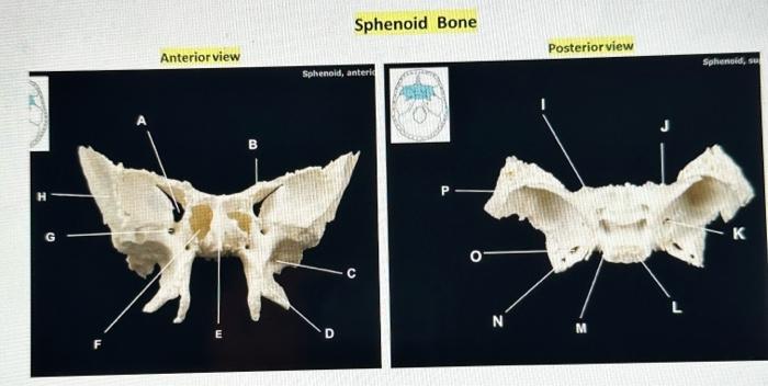 Solved Sphenoid Bone Posterior view Spheneld, sul | Chegg.com