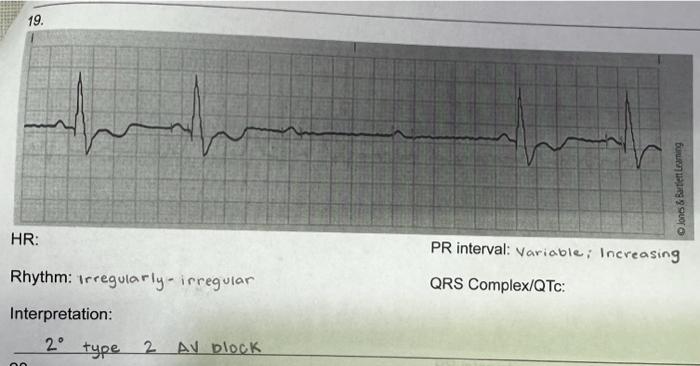 Solved Rhythm: irregularly - irregular Interpretation: 2∘ | Chegg.com