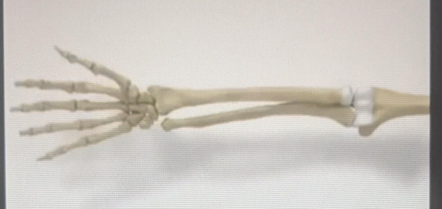 Solved What two movements occur when the hand and arm are | Chegg.com