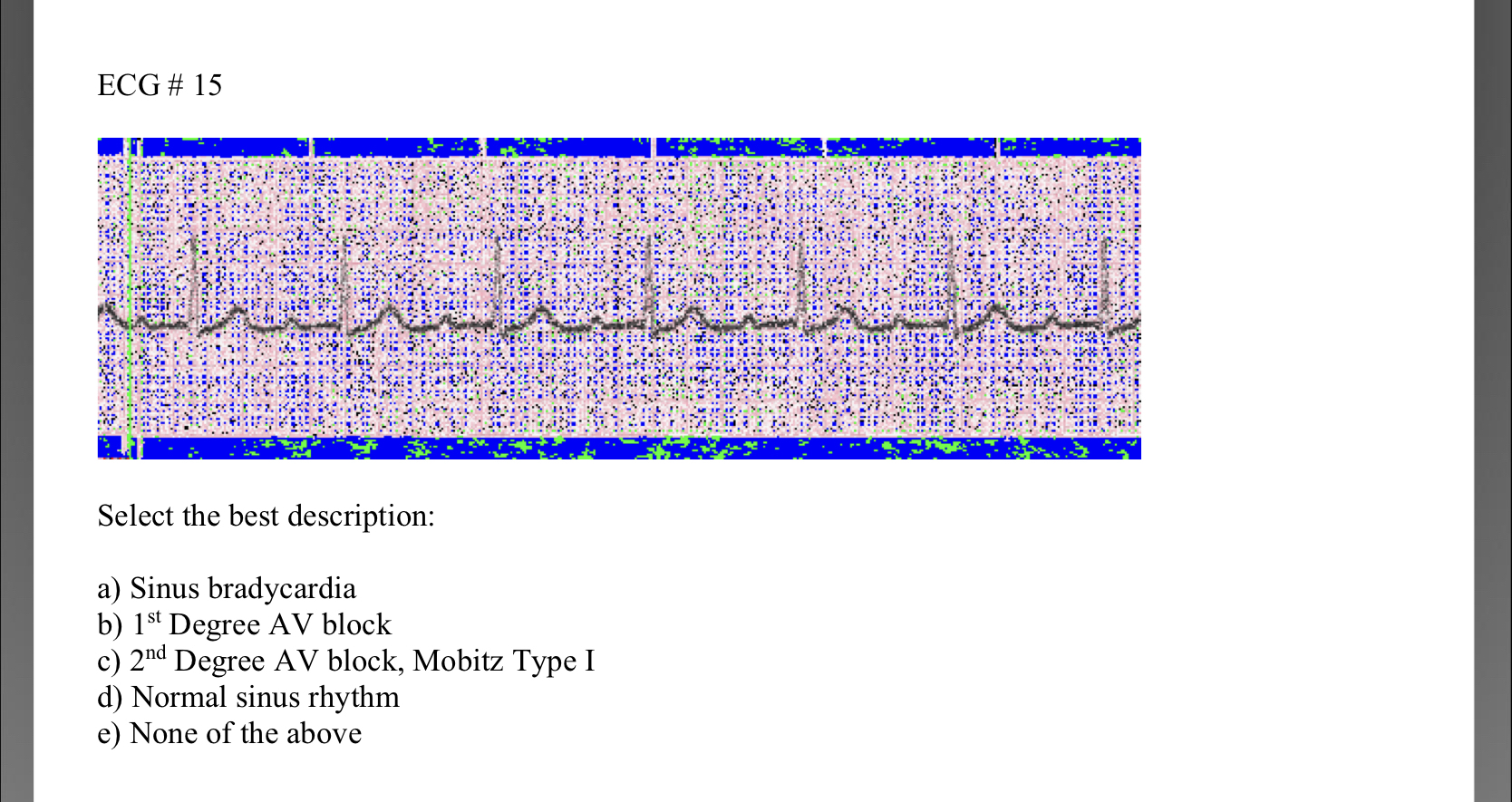 Solved ECG # 15Select the best description:a) ﻿Sinus | Chegg.com