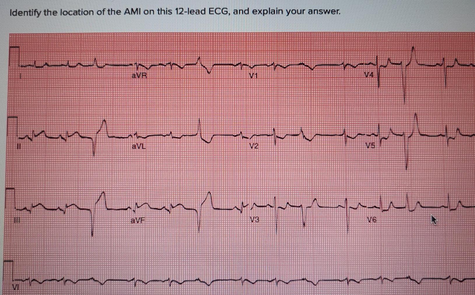 Solved Identify the location of the AMI on this 12-lead ECG, | Chegg.com