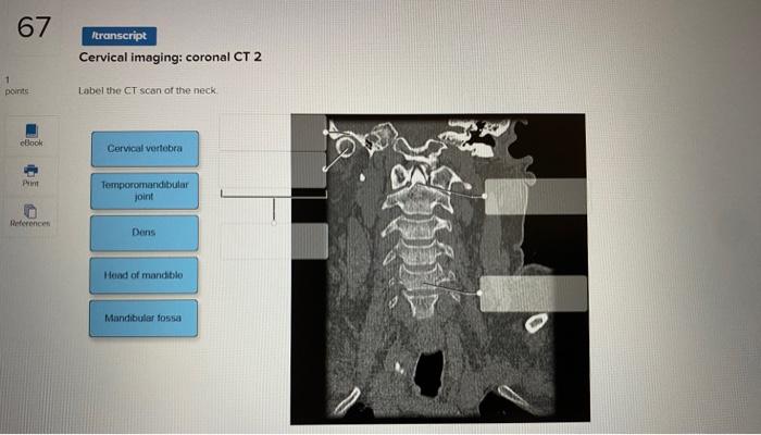 Solved Cervical imaging: coronal CT 2 Label the CT scan of | Chegg.com