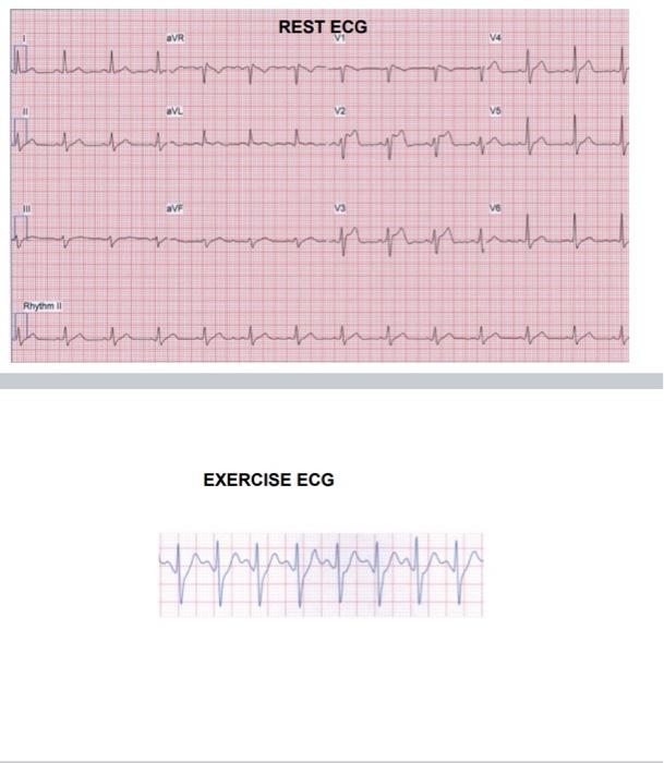 Solved Using the “rest ECG” attached to this assignment, | Chegg.com