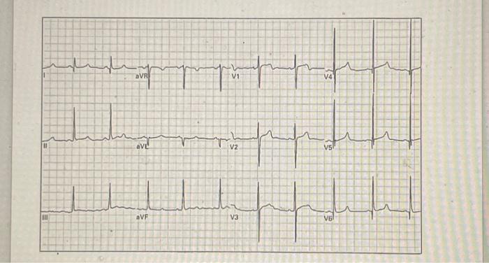 Identify for each: Step 1-Rhythm Step 2 -Rate Step | Chegg.com