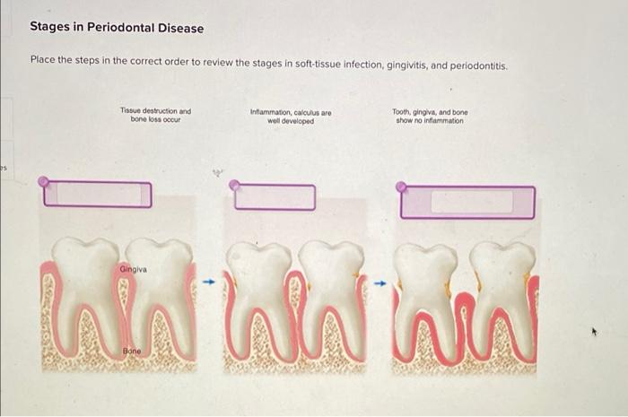 Solved Stages in Periodontal Disease Place the steps in the | Chegg.com