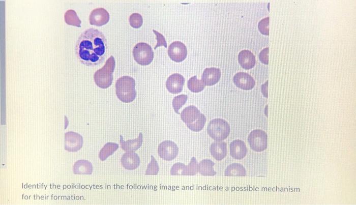 Identify the poikilocytes in the following image and | Chegg.com