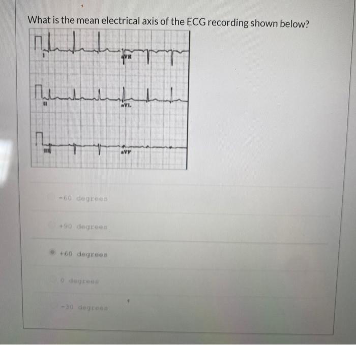 Solved What is the mean electrical axis of the ECG recording | Chegg.com