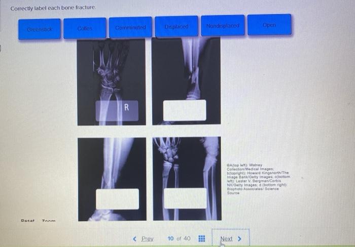 Solved Correctly label each bone fracture Colles Grock | Chegg.com