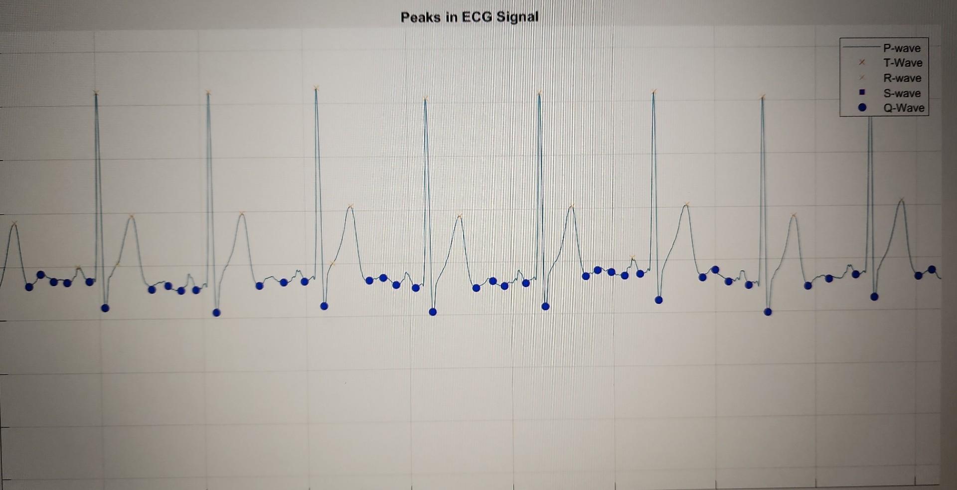 I Used This Code In Matlab To Detect Pqrst Peaks In