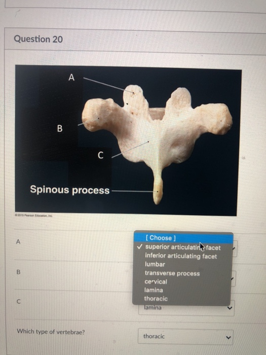 Solved Question 20 А B Spinous process 2010 Pene А B [Choose | Chegg.com