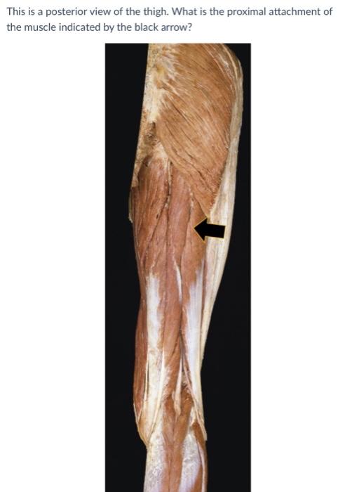 Solved lateral lip of linea aspera medial tibial condyle | Chegg.com