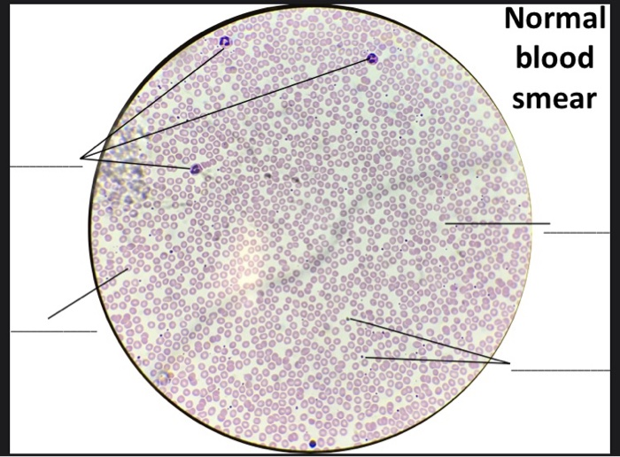 Solved Normal blood smear Dx: Dx: | Chegg.com