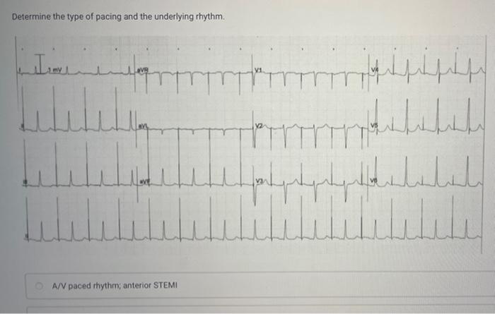 Solved Determine the type of pacing and the underlying | Chegg.com