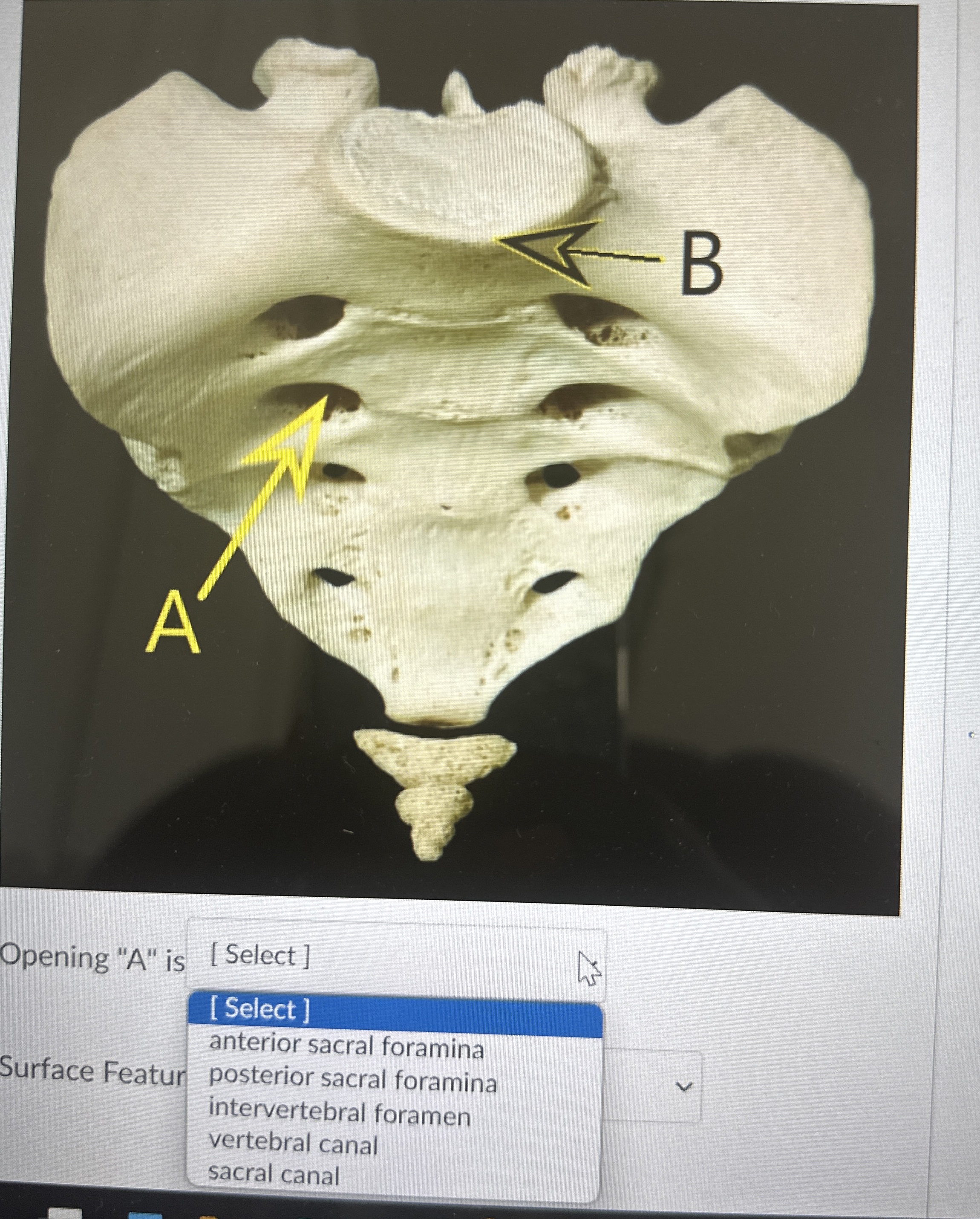 Solved Opening " A " ﻿is [ ﻿Select][ ﻿Select ]anterior | Chegg.com