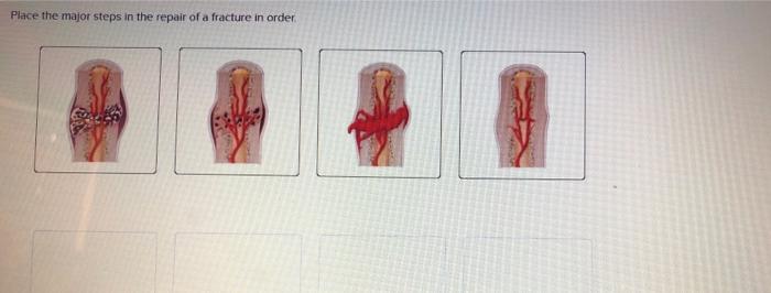 Solved Place the major steps in the repair of a fracture in | Chegg.com