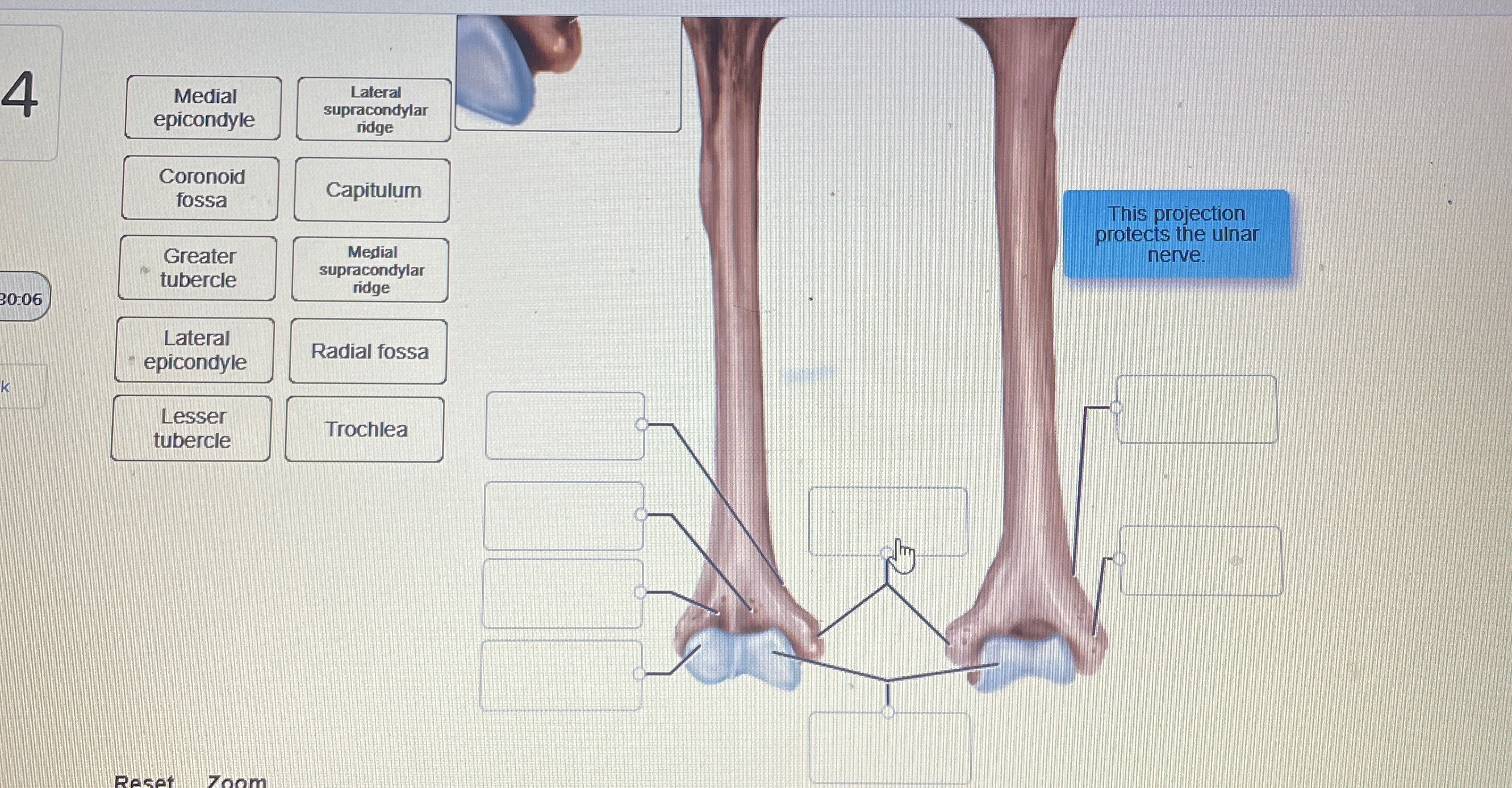 4MedialLateralepicondylesupracondylarridgeCoronoid | Chegg.com